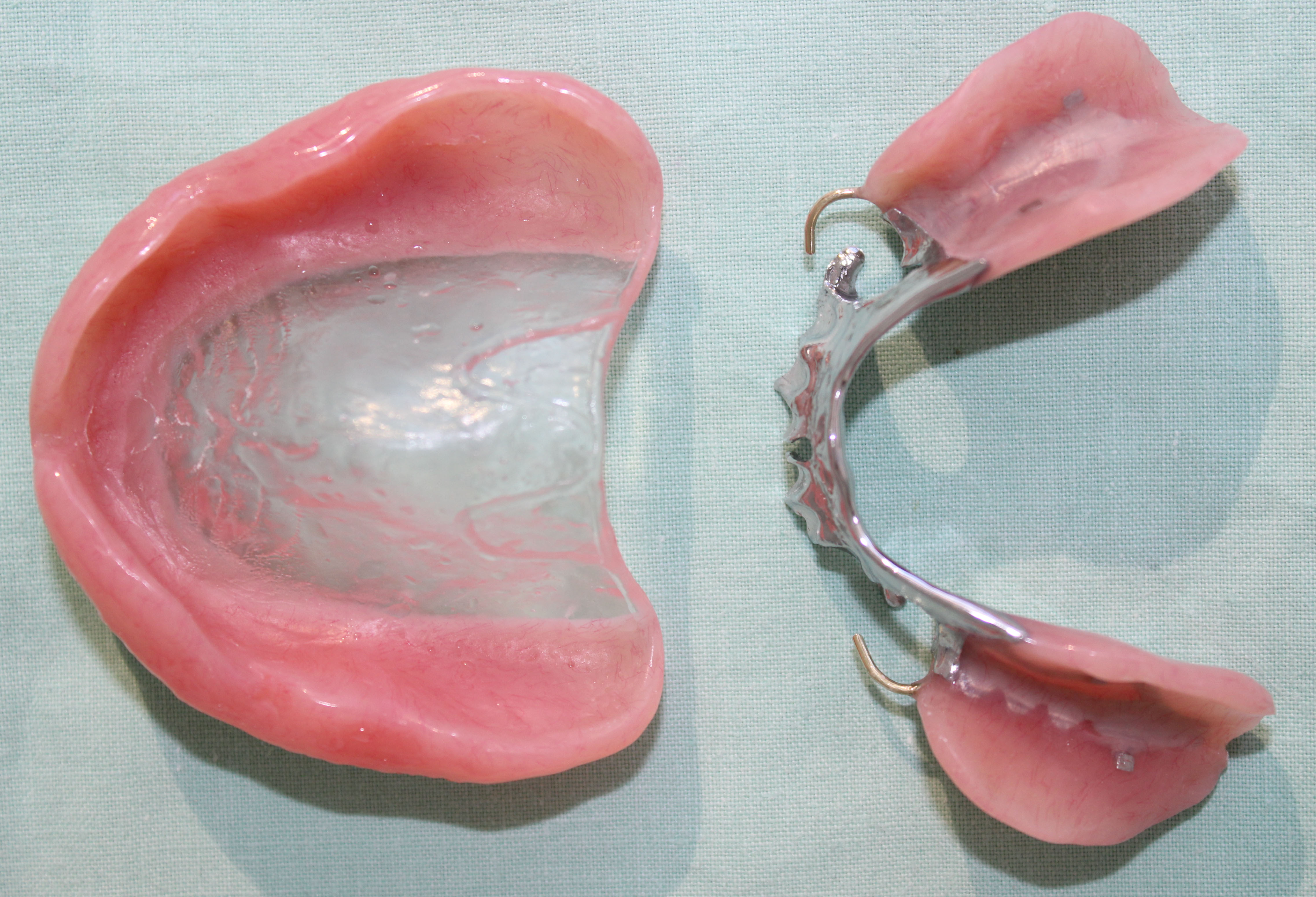 3-lower-metal-partial-denture-and-a-complete-upper-denture
