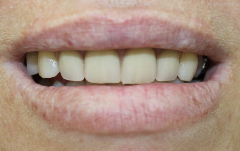 Partial Dentures (plates) - Northland Prosthodontics - Northland ...