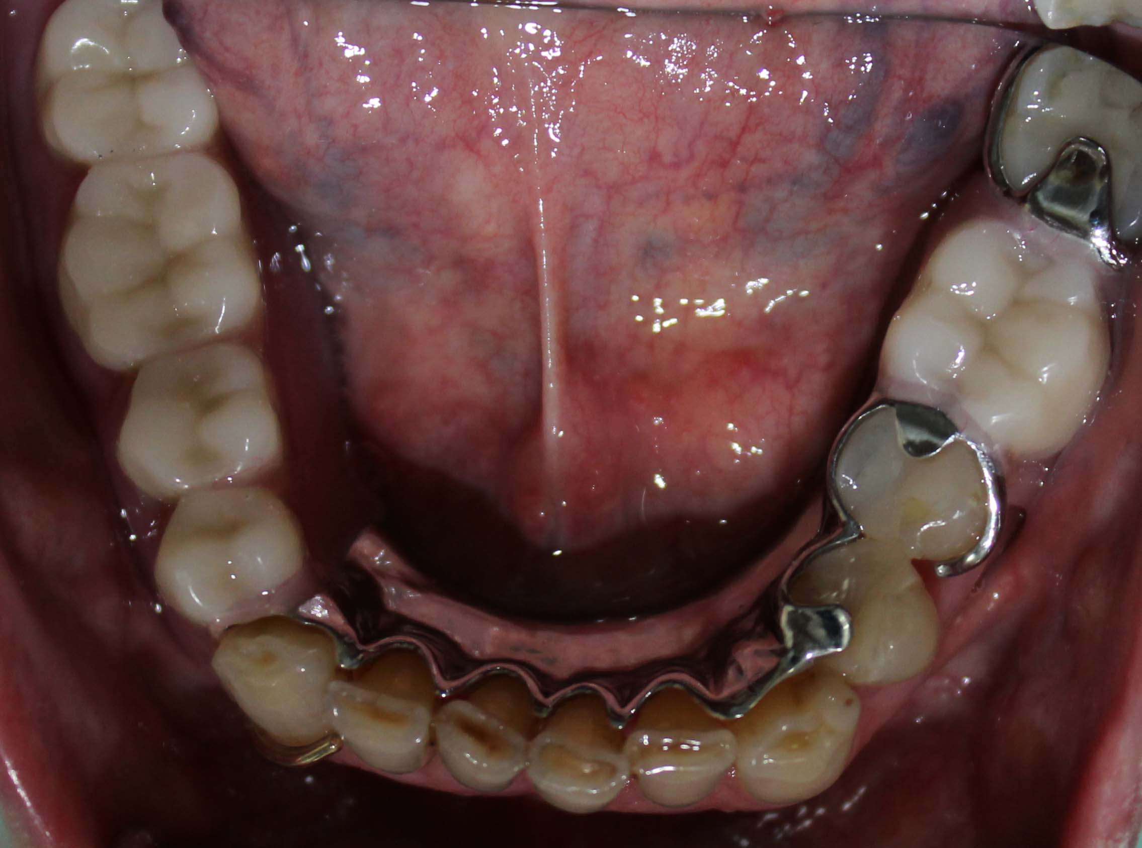 6-case-1-after-lower-metal-denture-fitted