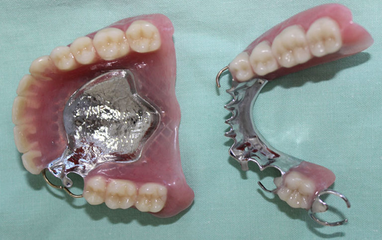 Partial Dentures (plates) - Northland Prosthodontics - Northland ...