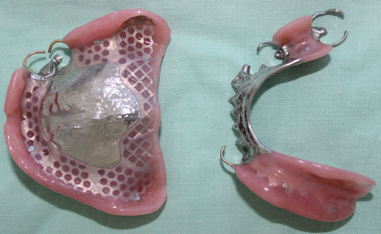 Partial Dentures (plates) - Northland Prosthodontics - Northland ...