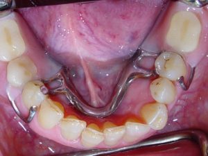 Partial Dentures (plates) - Northland Prosthodontics - Northland ...