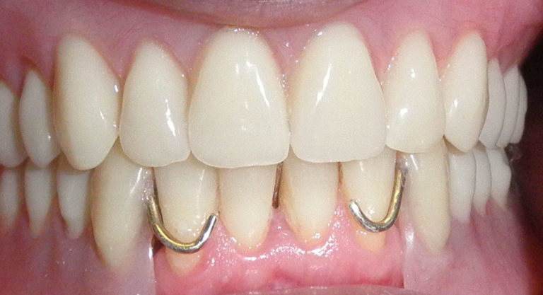 Partial Dentures (plates) - Northland Prosthodontics - Northland ...