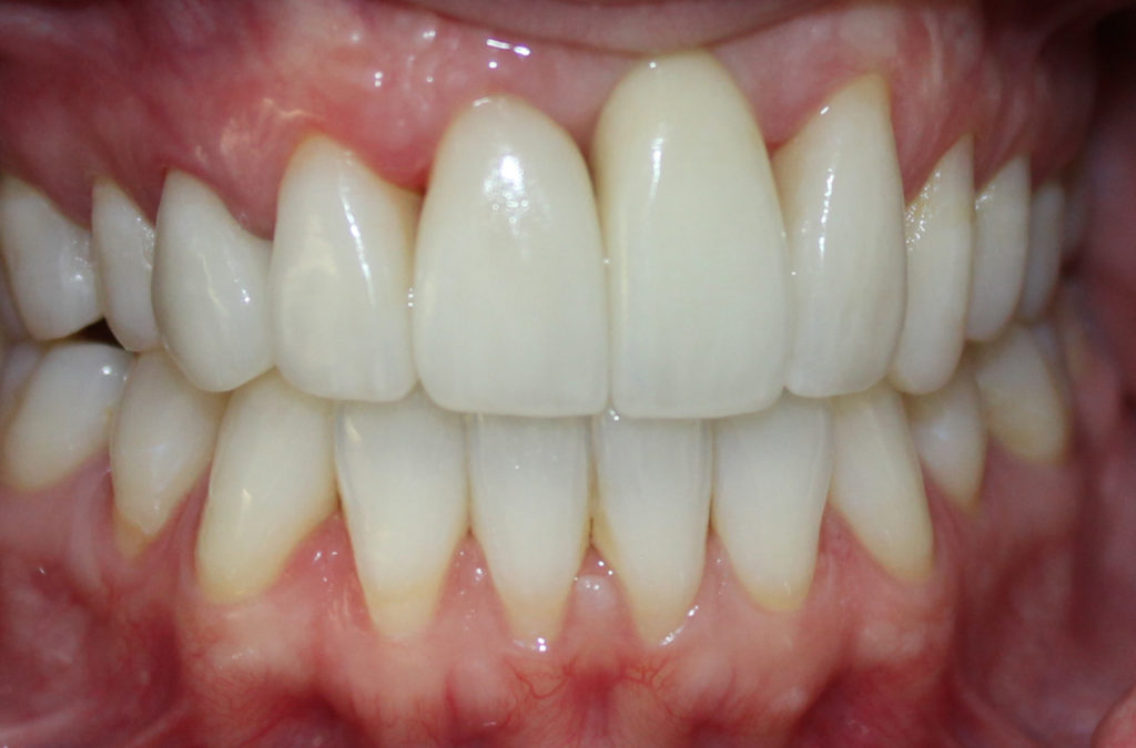 REPLACEMENT UPPER CROWNS - Northland Prosthodontics - Northland Denture ...