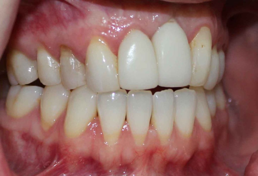 REPLACEMENT UPPER CROWNS - Northland Prosthodontics - Northland Denture ...