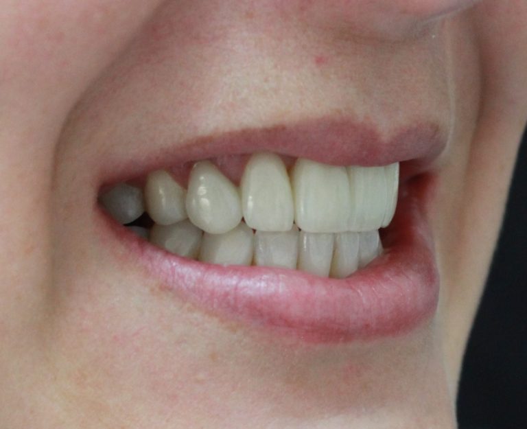 REPLACEMENT UPPER CROWNS - Northland Prosthodontics - Northland Denture ...