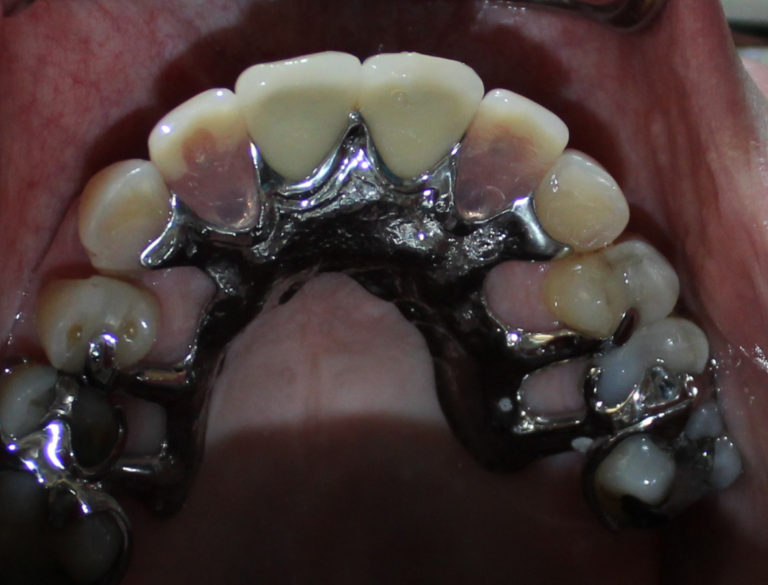Partial Dentures (plates) - Northland Prosthodontics - Northland ...
