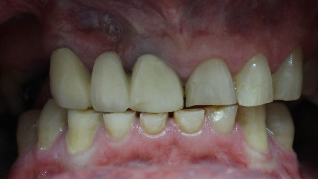 Tooth Grinding and TMJ Joint Disorders - Northland Prosthodontics ...