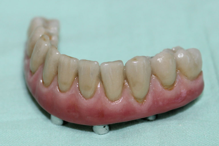 ALL-ON-FOUR LOWER JAW IMPLANT BRIDGE - PORCELAIN FUSED TO METAL ...