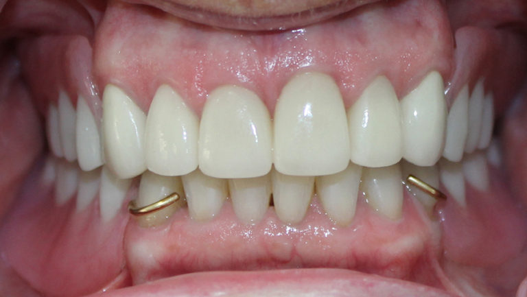 ALSO COSMETIC CROWNS AND PRECISION PARTIAL DENTURES - Northland ...