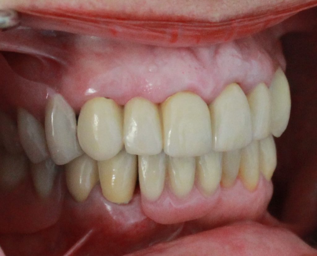 COSMETIC CROWNS AND PRECISION PARTIAL DENTURES - Northland ...
