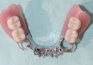 Partial Dentures (plates) - Northland Prosthodontics - Northland ...