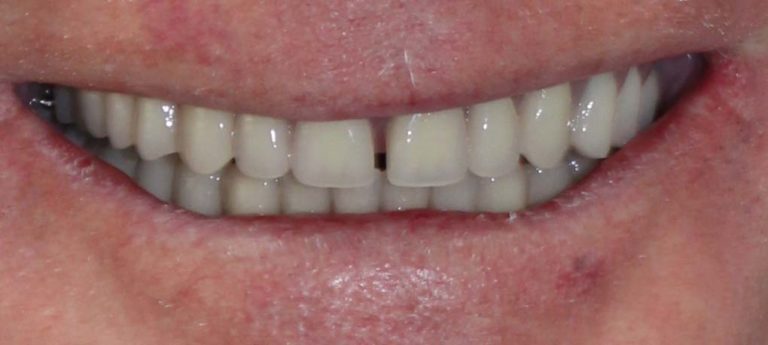 MAKEOVER WITH NEW UPPER METAL ROOT OVERDENTURE AND LOWER IMPLANT ...