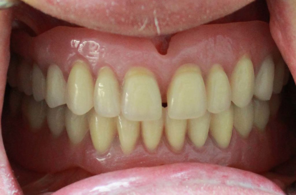 MAKEOVER WITH NEW UPPER METAL ROOT OVERDENTURE AND LOWER IMPLANT ...