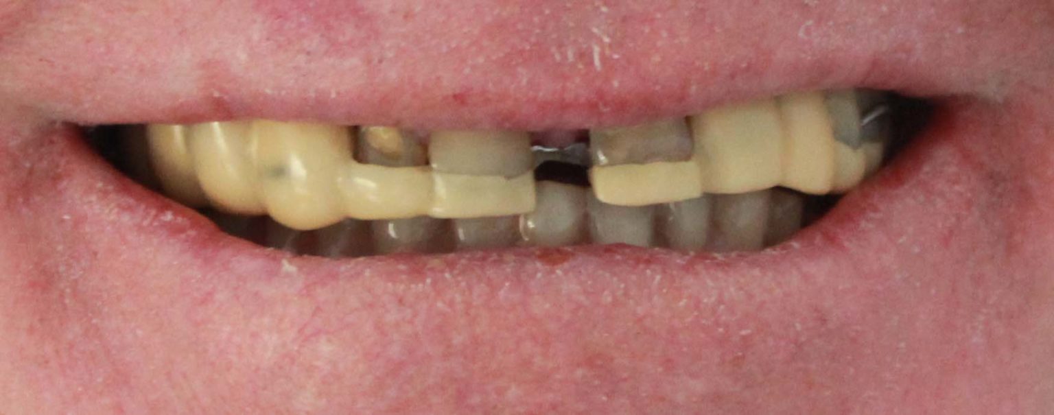 MAKEOVER WITH NEW UPPER METAL ROOT OVERDENTURE AND LOWER IMPLANT ...