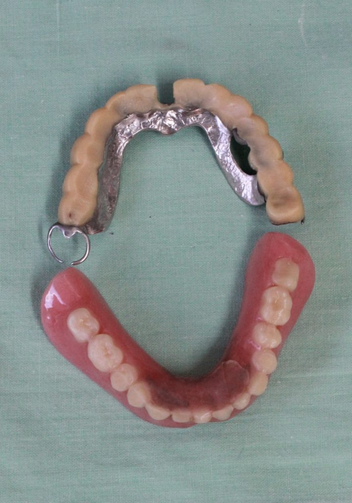 MAKEOVER WITH NEW UPPER METAL ROOT OVERDENTURE AND LOWER IMPLANT ...