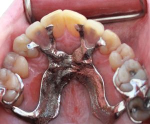 Partial Dentures (plates) - Northland Prosthodontics - Northland ...