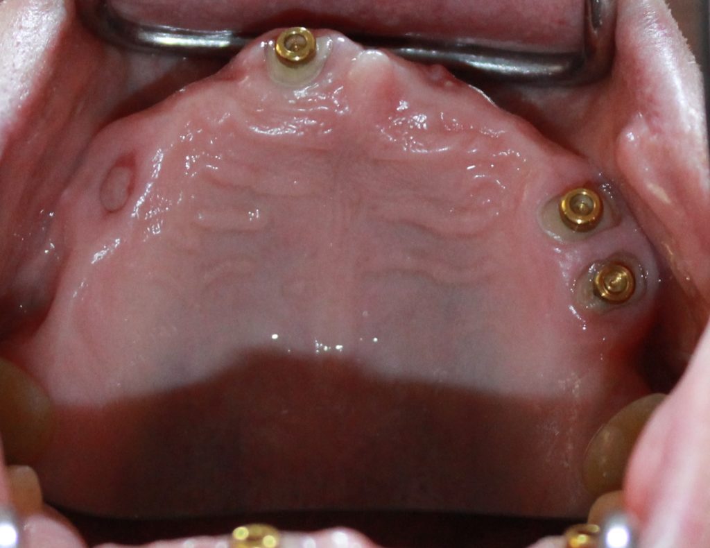 MAKEOVER WITH NEW UPPER METAL ROOT OVERDENTURE AND LOWER IMPLANT ...