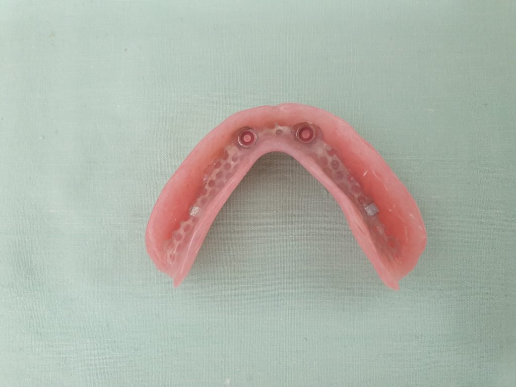 MAKEOVER WITH NEW UPPER METAL ROOT OVERDENTURE AND LOWER IMPLANT ...