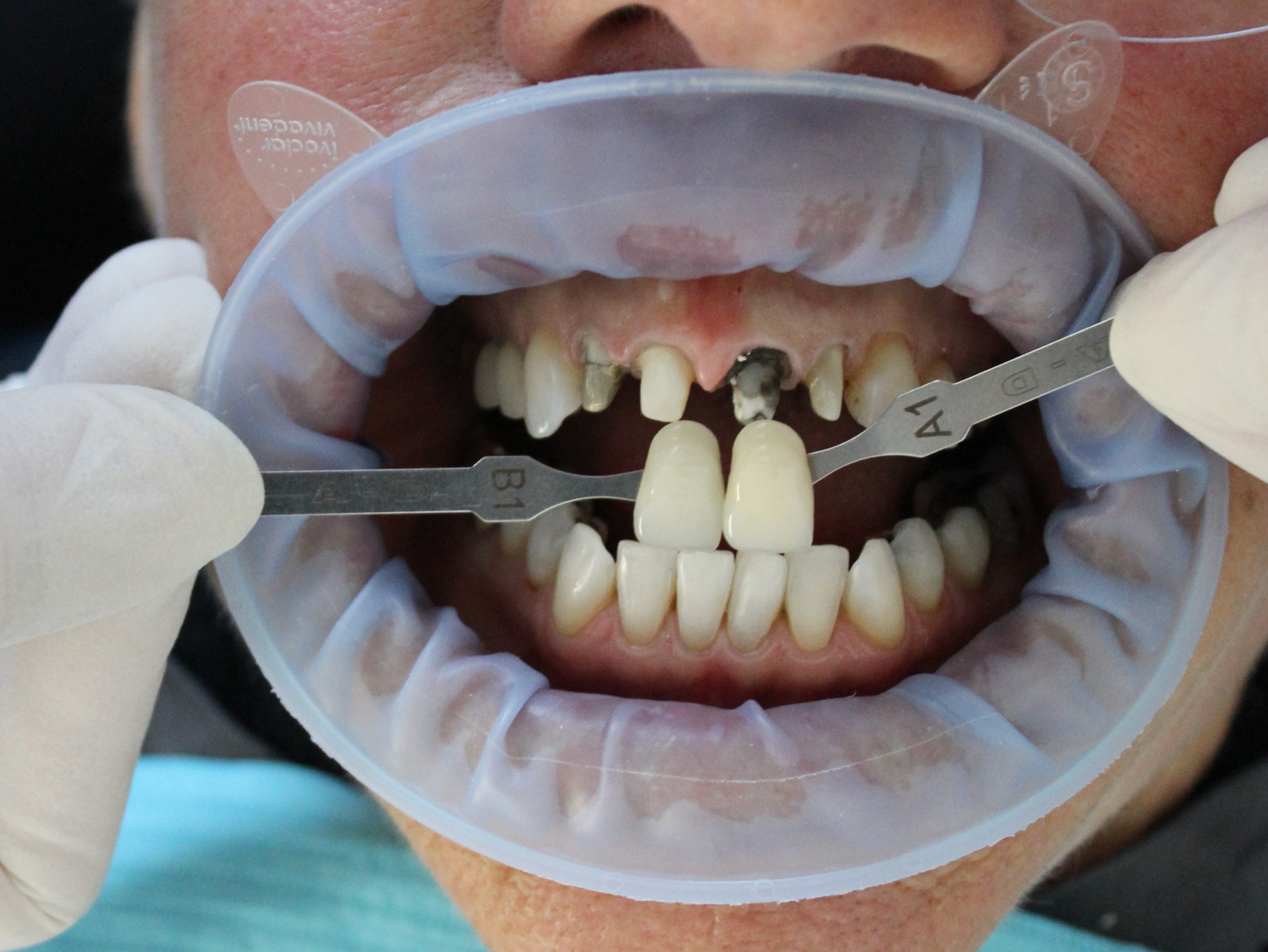 REPLACEMENT ALL CERAMIC CROWNS AND MASKING DARK COLOUR OF TEETH REPLACEMENT ALL CERAMIC CROWNS AND MASKING DARK COLOUR OF TEETH