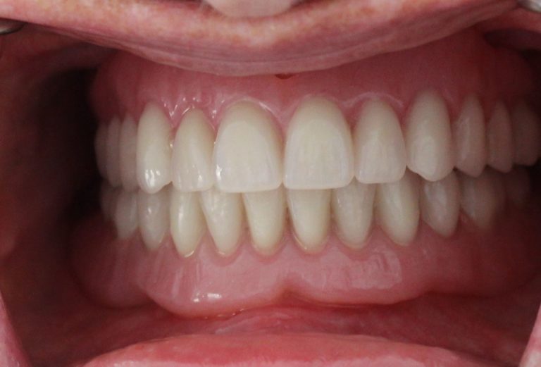 ALL-ON-FOUR LOWER IMPLANT BRIDGE - ALL CERAMIC - Northland ...