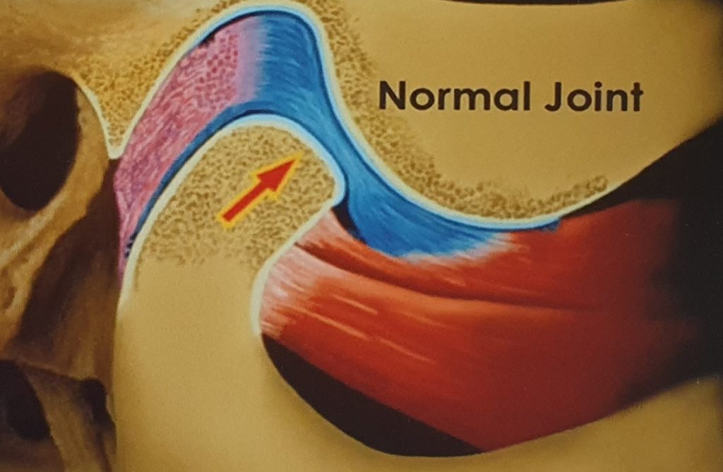 Tooth Grinding and TMJ Joint Disorders - Northland Prosthodontics ...