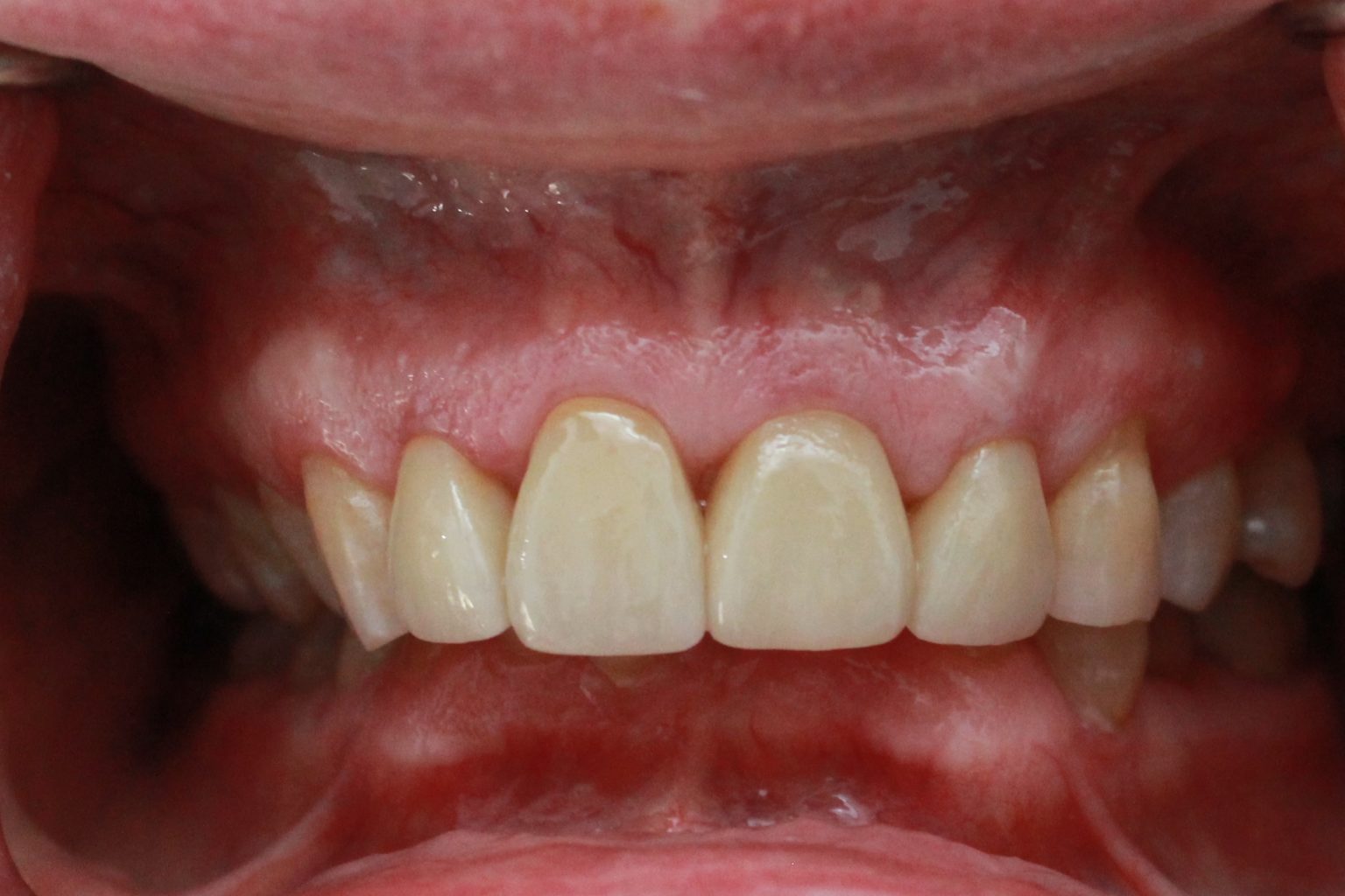 SMILE MAKEOVER WITH GUM SURGERY, IMPLANT CROWN AND NORMAL CROWNS ...