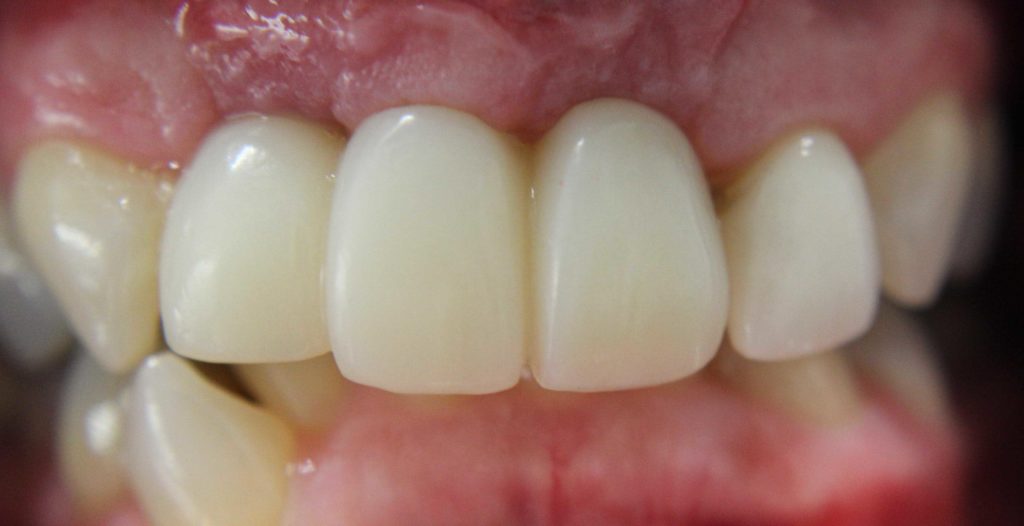 SMILE MAKEOVER WITH IMPLANT BRIDGE - Northland Prosthodontics ...