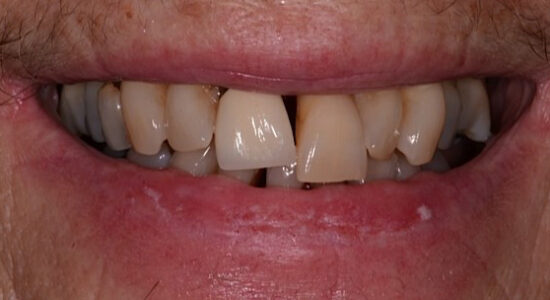Partial Dentures (plates)