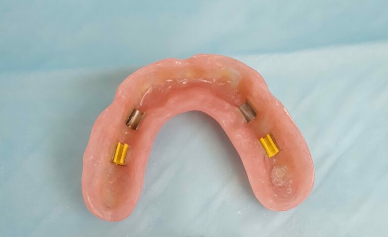 Implant Dentures (Complete)