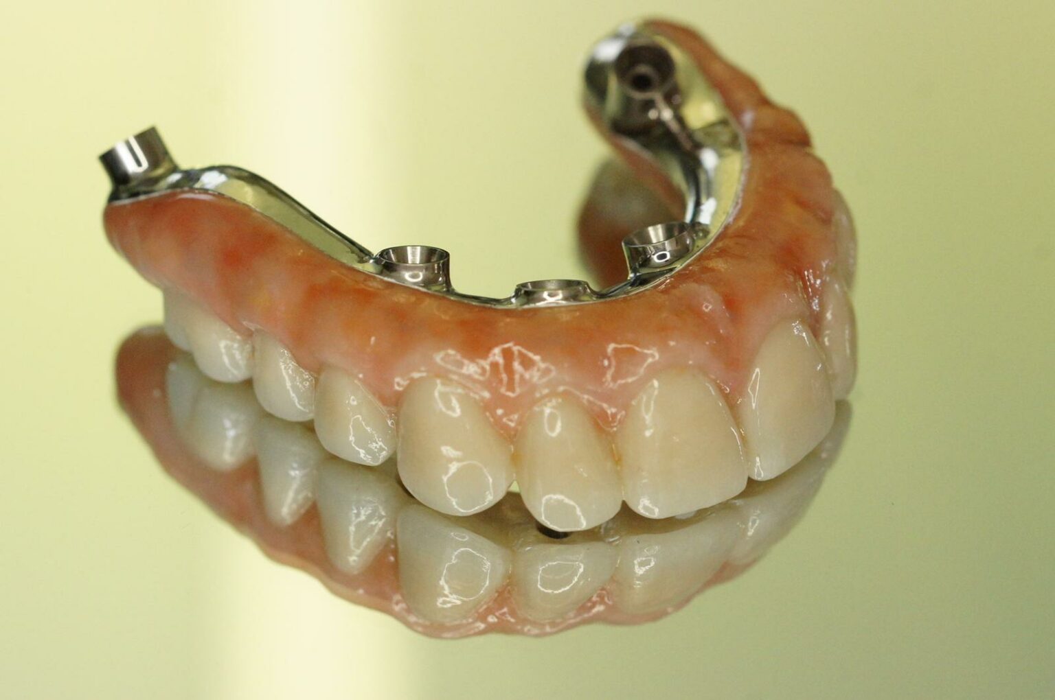Implant Bridges