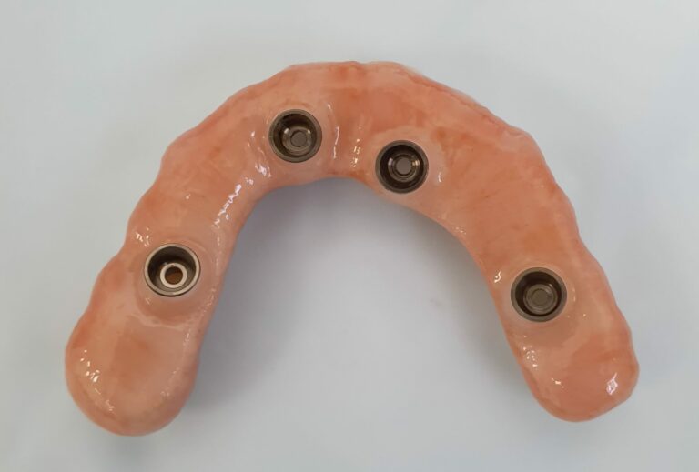 Implant Bridges