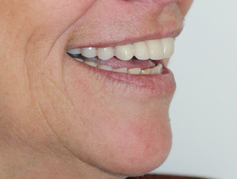 Partial Dentures (plates)