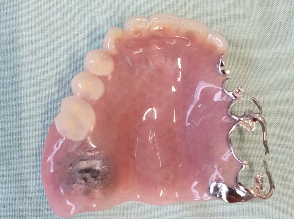 Partial Dentures (plates)