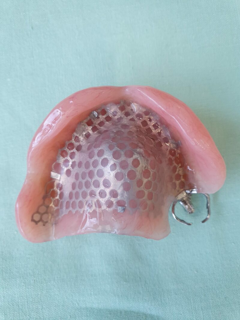 Partial Dentures (plates)