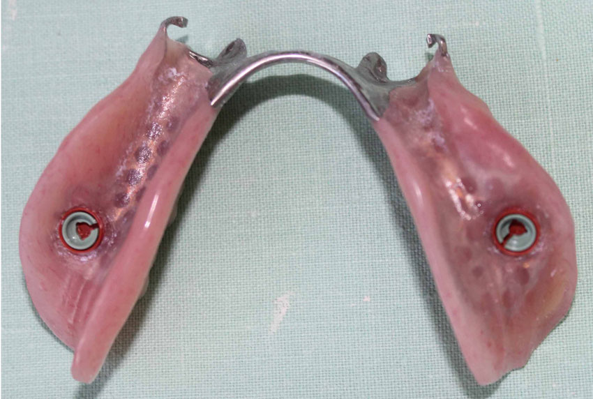 Implant Dentures (Partial)