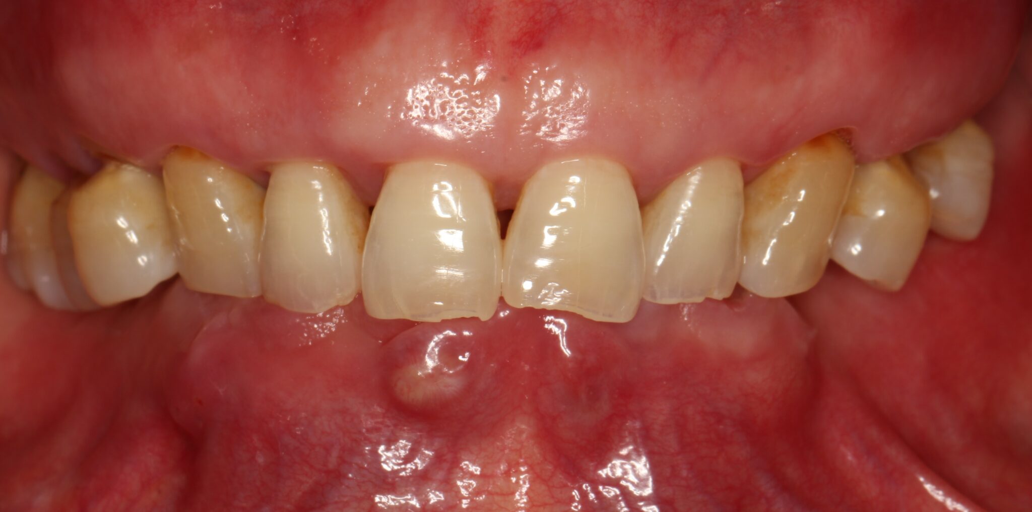 Lady with severe deep bite and worn lower teeth wants a solution ...