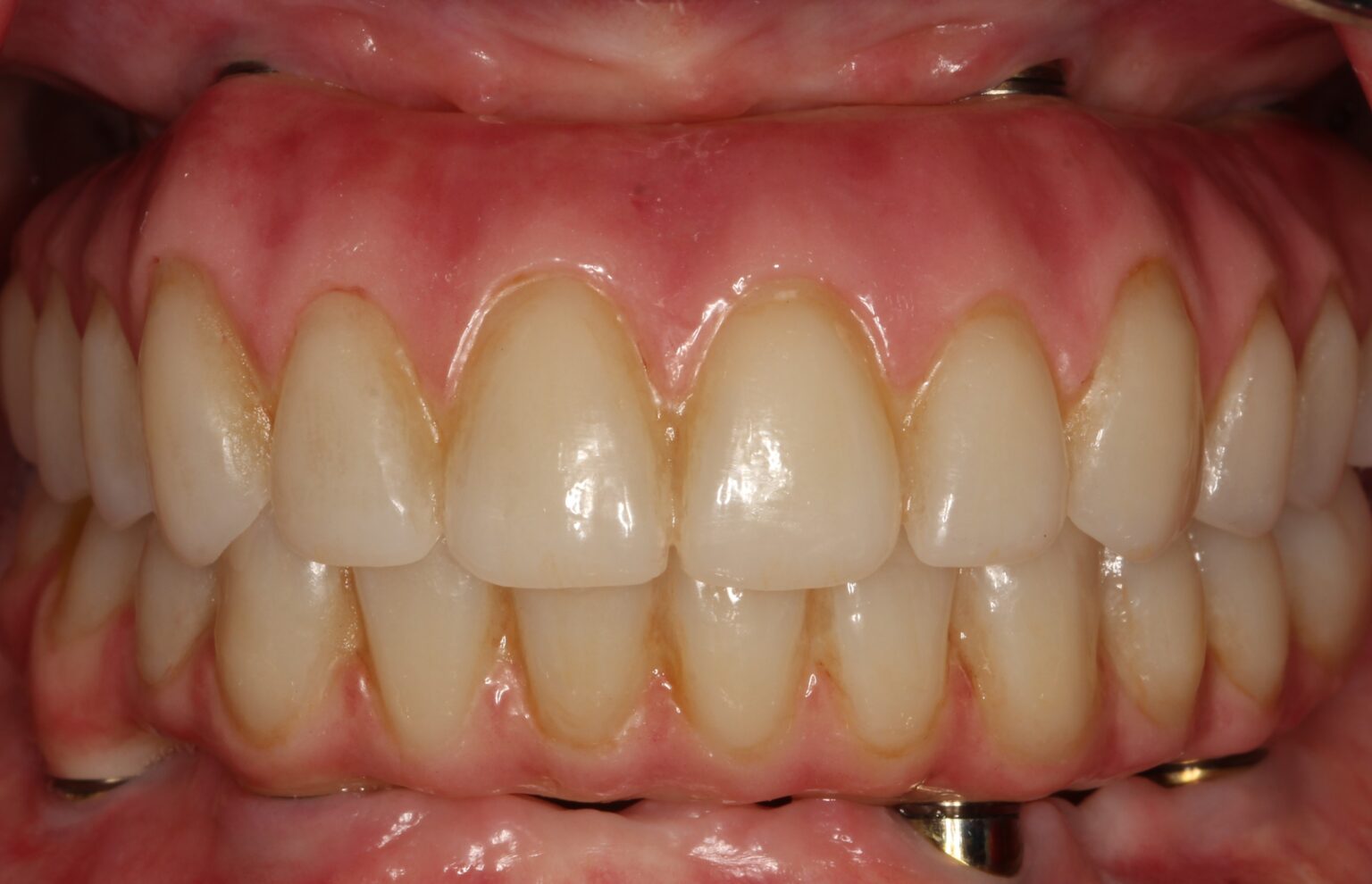 Compilation of 5-year follow-up of full arch fixed implant bridges ...