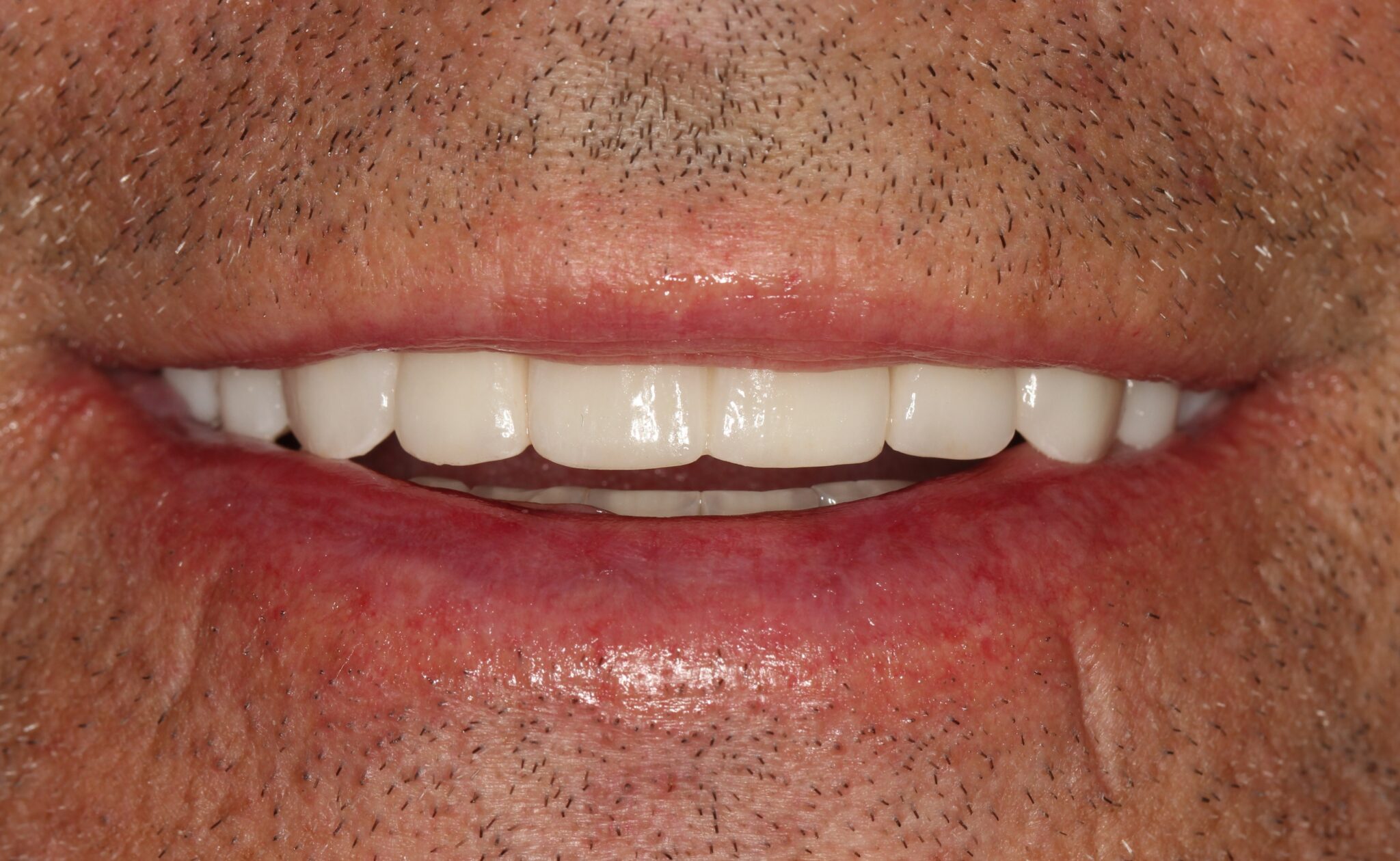 Compilation of 5-year follow-up of full arch fixed implant bridges ...