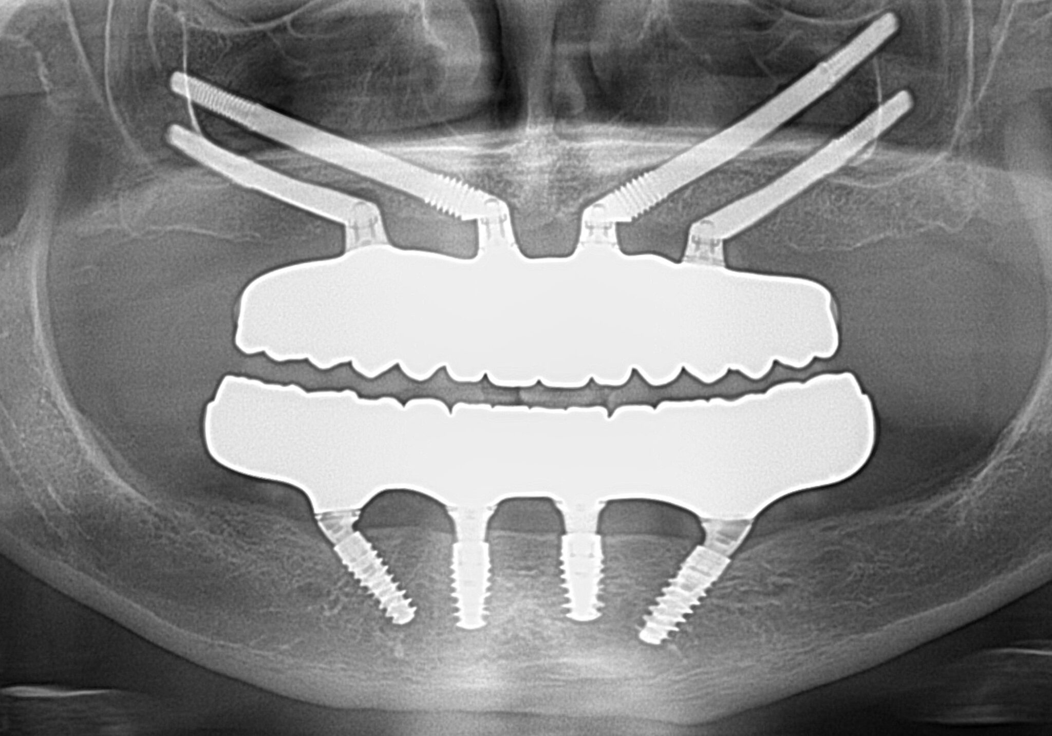 Compilation of 5-year follow-up of full arch fixed implant bridges ...
